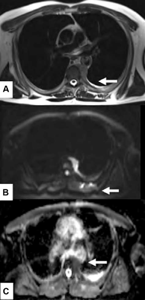 A 66 Year Old Man With Left Paraspinal Mass Arrow That Is Low In Download Scientific Diagram