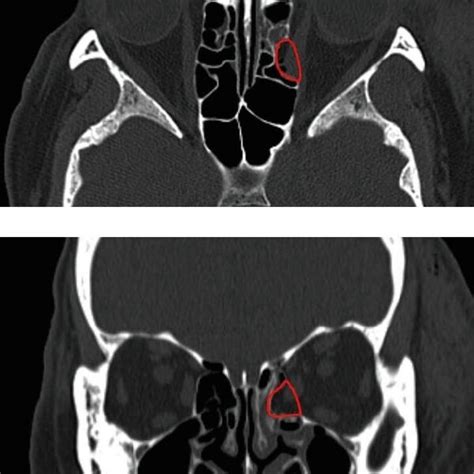 A 61 Year Old Man With A History Of A Medial Orbital Wall Fracture