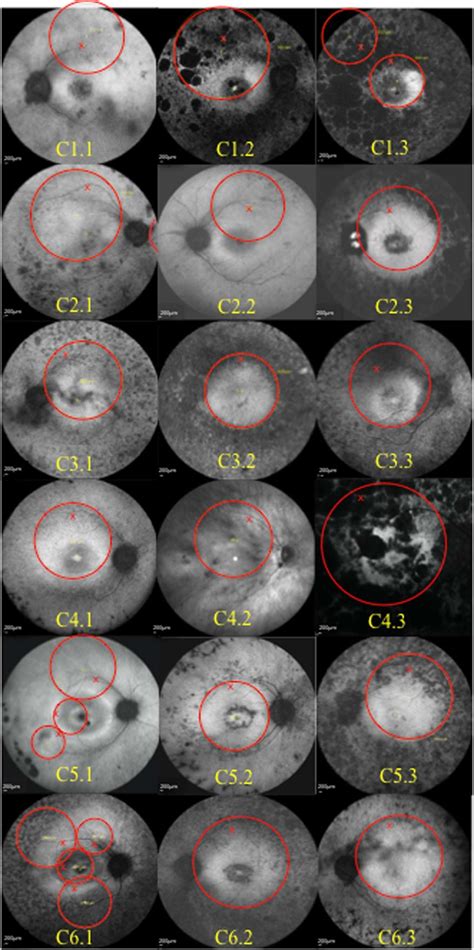 Site Of Subretinal Bleb S Post Gene Therapy In All 18 Trial Download Scientific Diagram