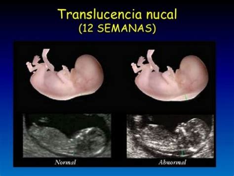 Ecografia Translucencia Nucal BabyCenter
