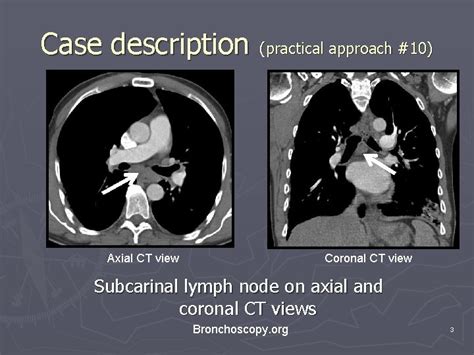 10 Planning Ebustbna Of Subcarinal Lymph Node Station