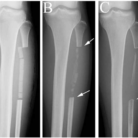 Pdf Osteoinduction And Osteoconduction With Porous Beta Tricalcium Phosphate Implanted After
