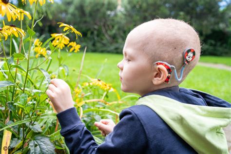 Cochlear Nucleus 8 Sound Processor Skins Stickers Disney Mickey Mickey Nucleus 8 Disney