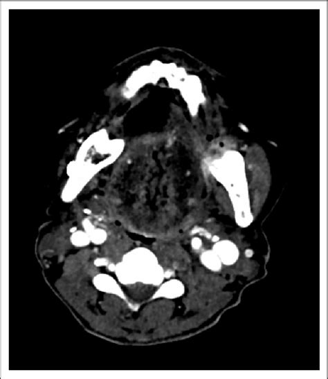 Contrast Enhanced Ct Scan Demonstrating The Lesion At The Retromolar