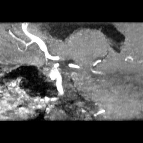 Radiopaedia Case Primitive Trigeminal Artery With Fetal Pcom Id 24041