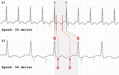 Atrial Flutter Litfl Ecg Library Diagnosis