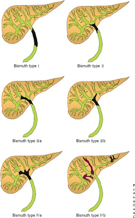 Table 1 From Current Surgical Management Of Hilar And Intrahepatic