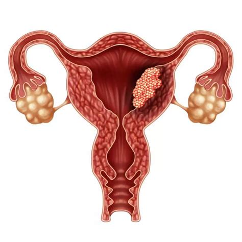 Symptoms Of Uterus Cancer In Females Bedaya Hospital