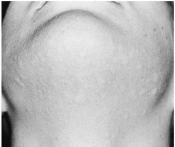 Lecture Part Allergy Swelling Hyperventilation Aspiration Swallowing Flashcards Quizlet