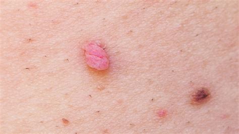 SKIN TAG Harmful Or Not