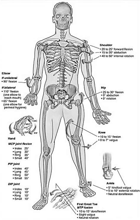 Arthrodesis Positions Epomedicine