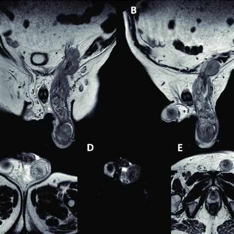 Macroscopic Findings In A Surgical Specimen Orchiectomy Of Ptl