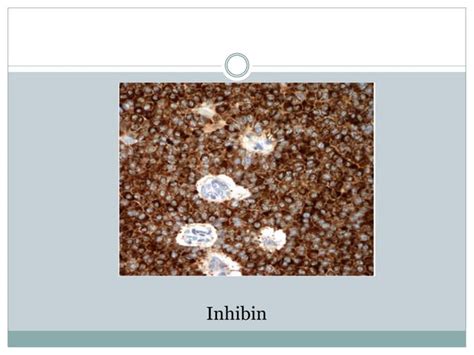 Sex Cord Stromal Tumors Pathology Ppt