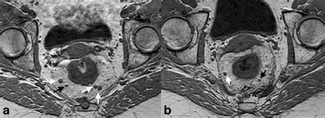 3d t1 weighted gradient echo images before a and after b crt the