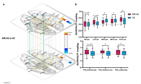 Figure 1 From Altered Metabolic Functional Coupling In The Epileptogenic Network Could Predict