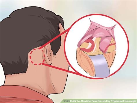 Cara Menyembuhkan Penyakit Trigeminal Neuralgia