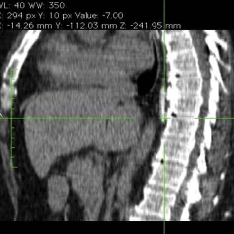 Anterior And Posterior Epidural Venous Plexus With Contrast Download