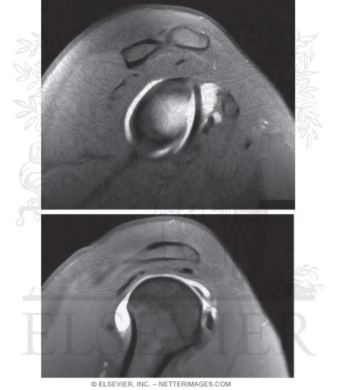 Shoulder Joint Glenoid Fossa