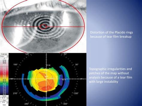 Corneal Topography Final Pptx