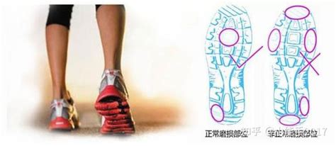 后足外翻问题对身体影响大，可穿矫正鞋应对 知乎