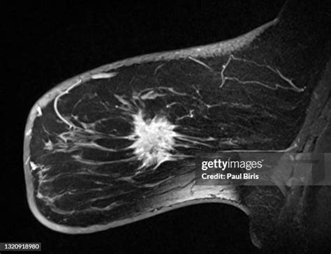 Sagital Mri Photos And Premium High Res Pictures Getty Images