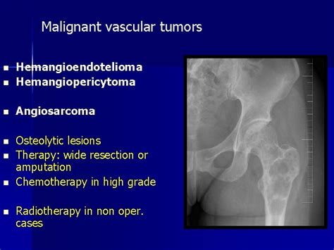 Malignant Bone Tumors Pazourek L Ondrek Osteosarcoma Malignant