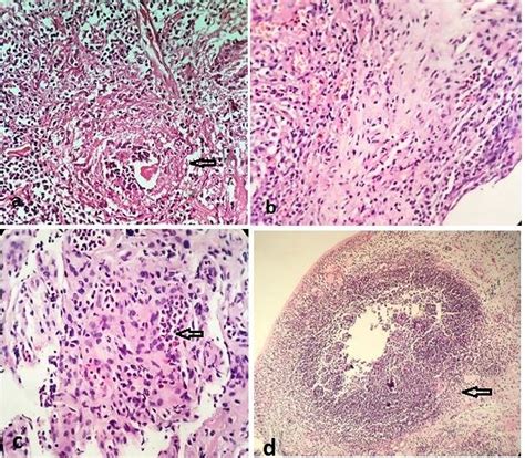 A Photomicrograph Of Tuberculous Cystitis Shows Confluent Granulomas Download Scientific