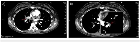 Bilateral Pulmonary Embolism On Ct Angiography A Filling Defect