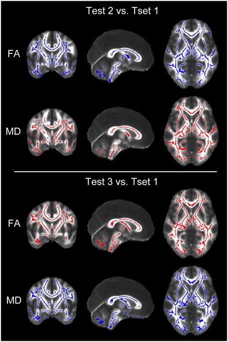 Statistical Maps Of Comparison Of Fractional Anisotropy Fa And Mean