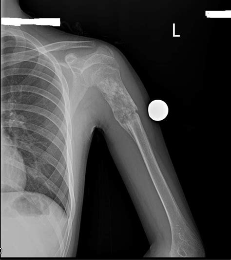 Монголд анх удаа мөрний хавдрыг авч хиймэл үе суулгах мэс заслыг амжилттай хийлээ