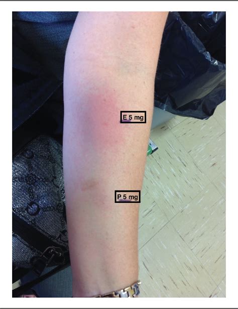 Figure 1 From A Rare Case Of Oestrogen Dermatitis Semantic Scholar