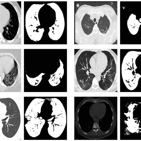 Sample Slices Of The Examined Analysis Cohort With Lung Segmentation
