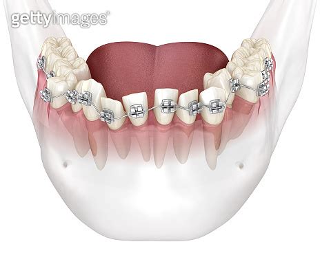 Abnormal Teeth Position And Correction With Metal Braces Tretament