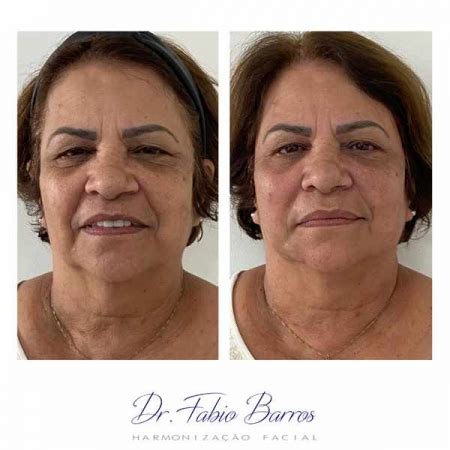 Harmonização Facial o Dr Fabio Barros