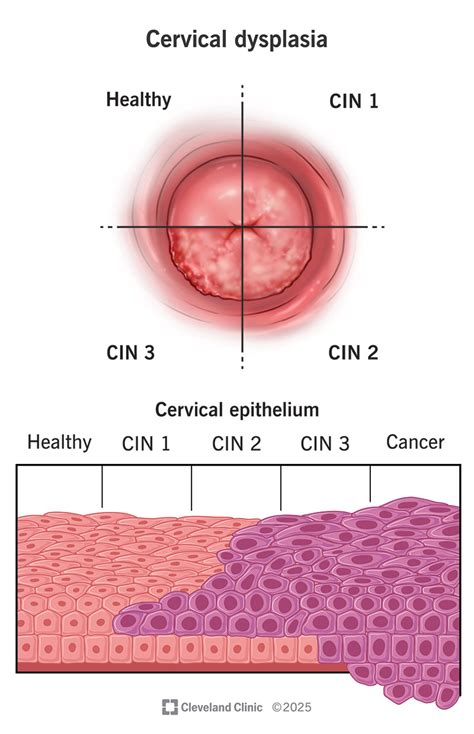 High Vs Low Cervix