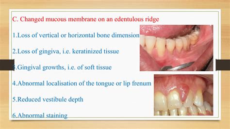 Periodontal Diseases Classificationpptx