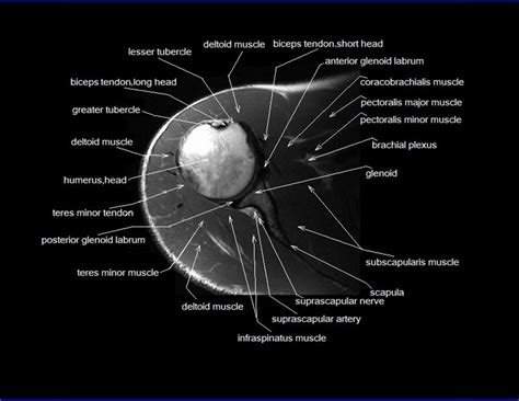 Shoulder Anatomy Mri Shoulder Axial Anatomy Free Cross Sectional