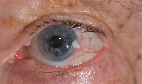 Eye Cancer Signs Watch Out For A Dark Spot On The Coloured Part Of The