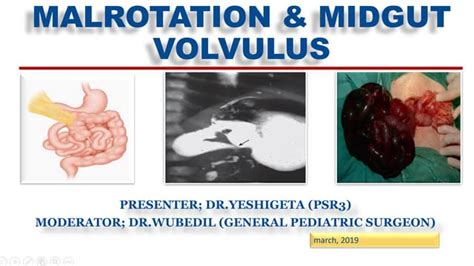 Volvulus Malrotation Intestinal Malrotation Varied Clinical