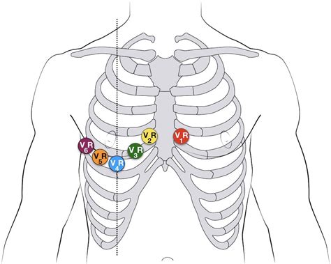 Right Ventricular Infarction • Litfl • Ecg Library Diagnosis