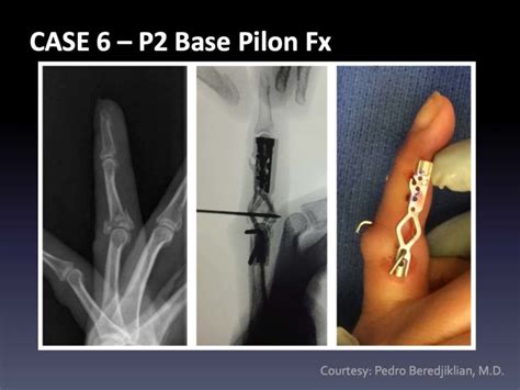 Case 6 P2 Base Pilon Fx Virak Orthopedics