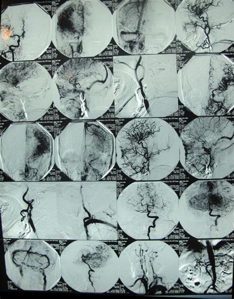 双侧颈动脉狭窄，频发tia 中风网