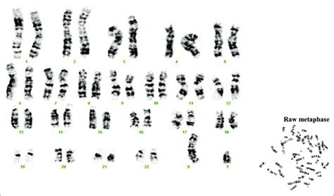 Karyogram From Cultured Human Buccal Fibroblasts Using Giemsa Staining
