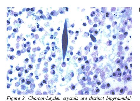 Figure 3 From Charcot Leyden Crystals Pathology And Diagnostic Utility