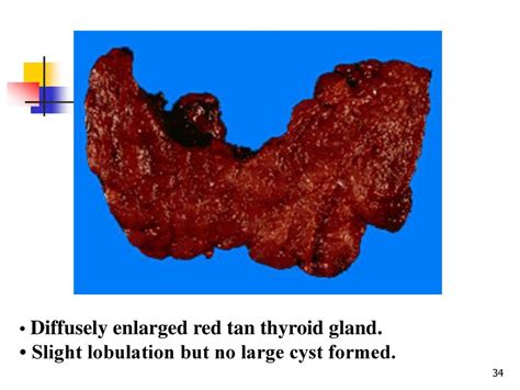 Diseases Of The Endocrine System Diseases Of The Thyroid Gland Ppt Download Diseases Of The Endocrine System Diseases Of The Thyroid Gland Ppt Download