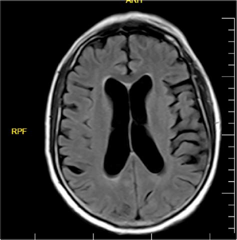 Brain Mri Flair Sequence Download Scientific Diagram