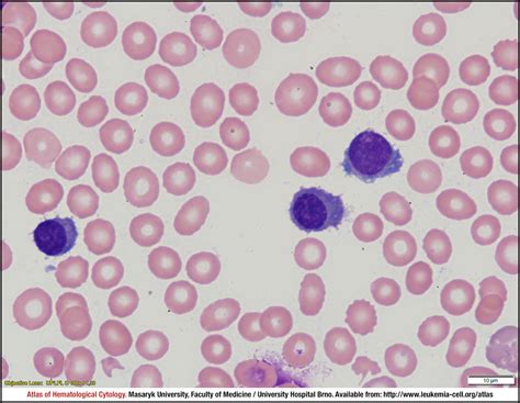 Plasma Cell Myeloma Cell Atlas Of Haematological Cytology