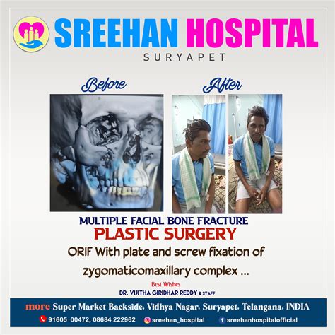 Orif With Plate And Screw Fixation Of Sreehan Hospital