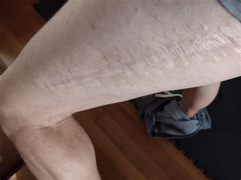 ~30cm Fasciotomy Scar Rscars