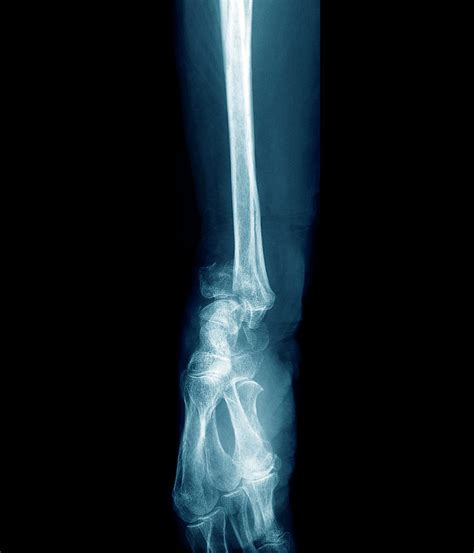 Colles Wrist Fracture Photograph By Zephyrscience Photo Library